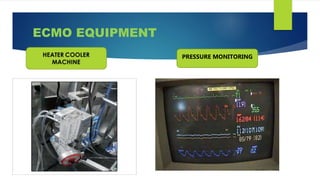Ecmo (Extracorporeal membrane oxygenation) | PPTX