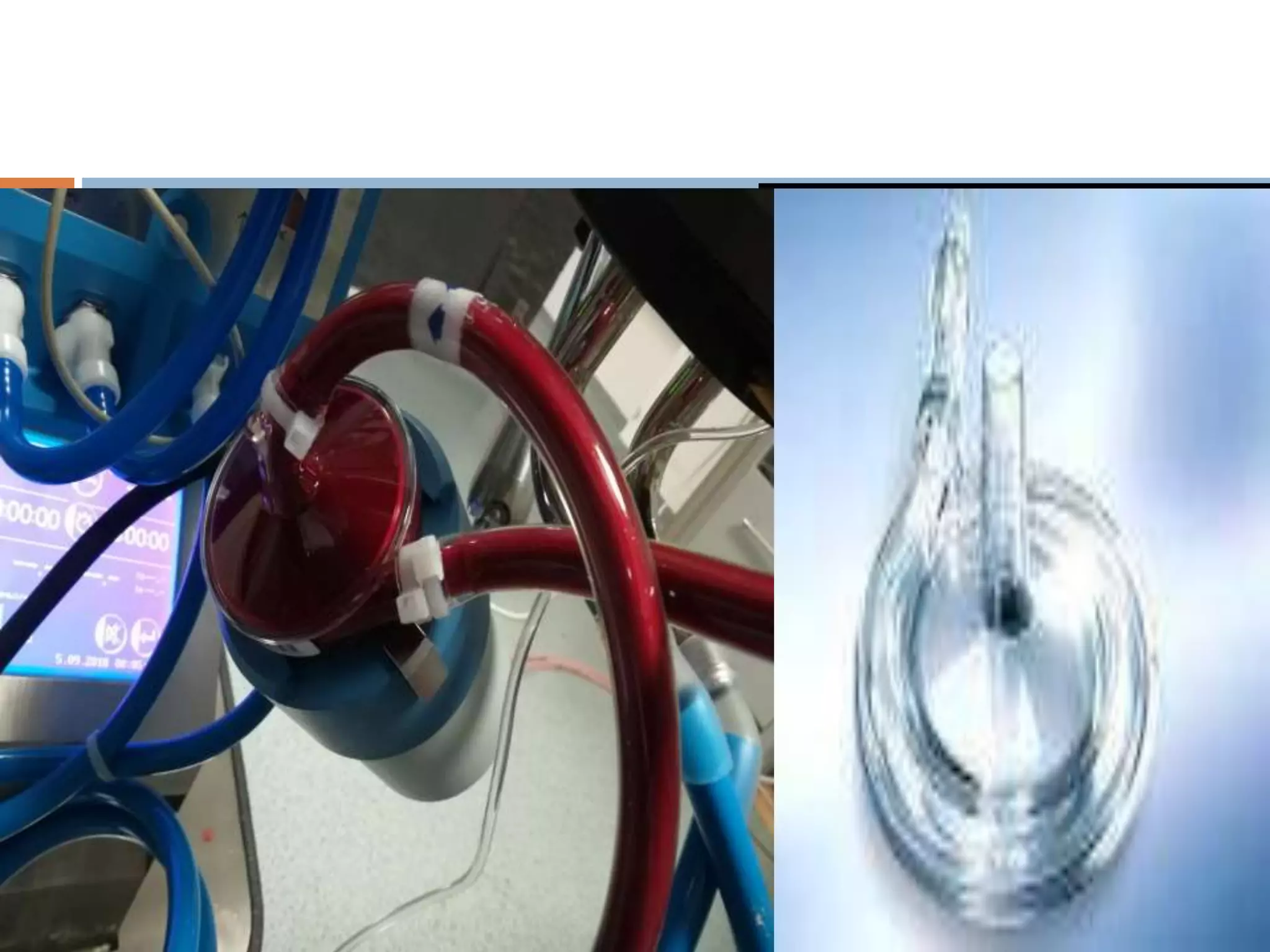Ecmo | PPT