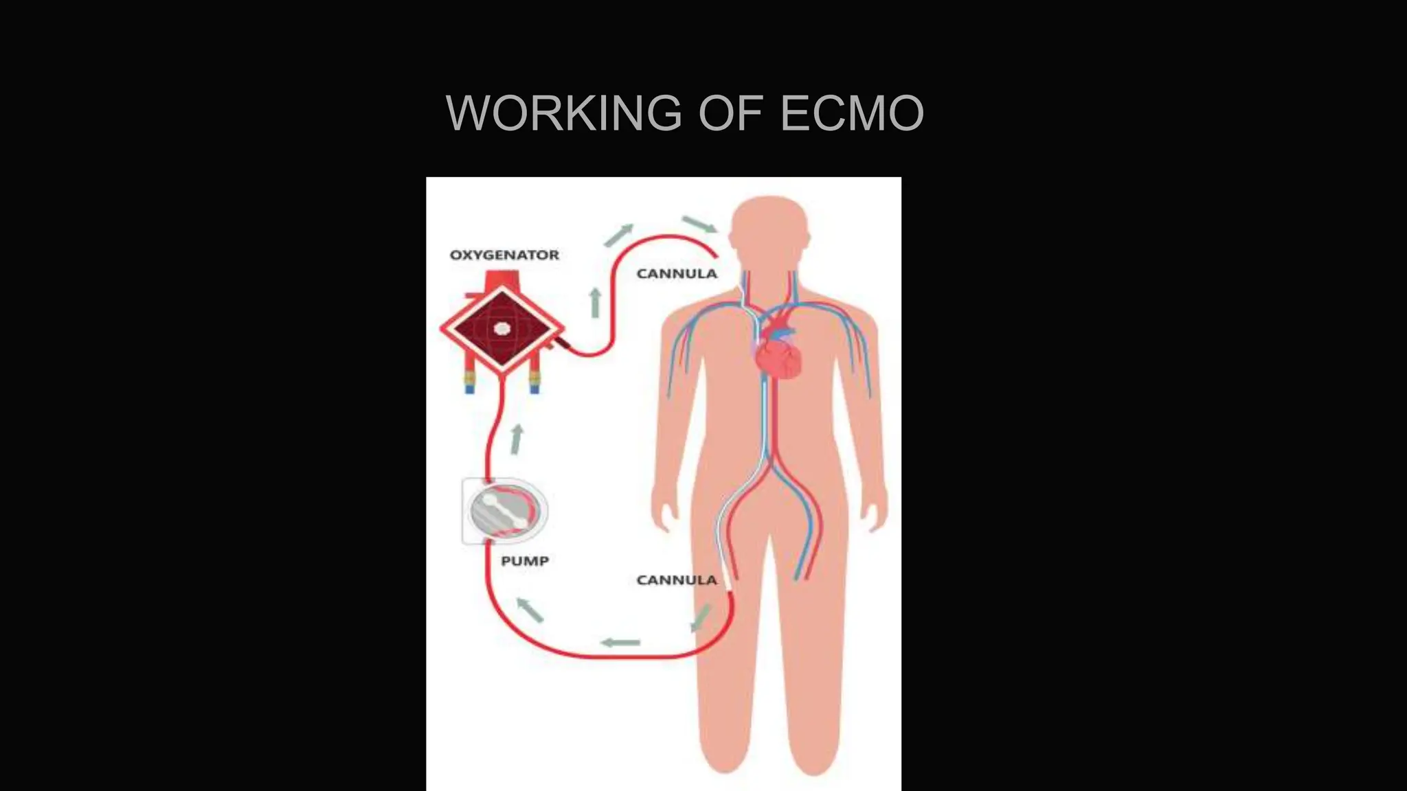 extracorporeal membrane oxygenation (ecmo) | PPTX