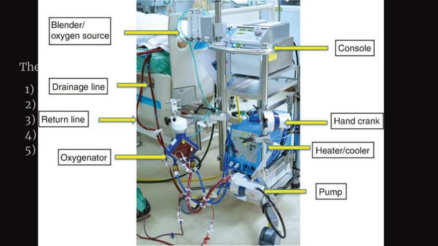 extracorporeal membrane oxygenation (ecmo) | PPTX | Lung and ...