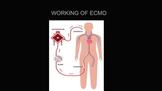 extracorporeal membrane oxygenation (ecmo) | PPTX