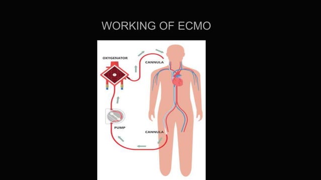 extracorporeal membrane oxygenation (ecmo) | PPTX | Lung and Respiratory Health | Diseases and ...