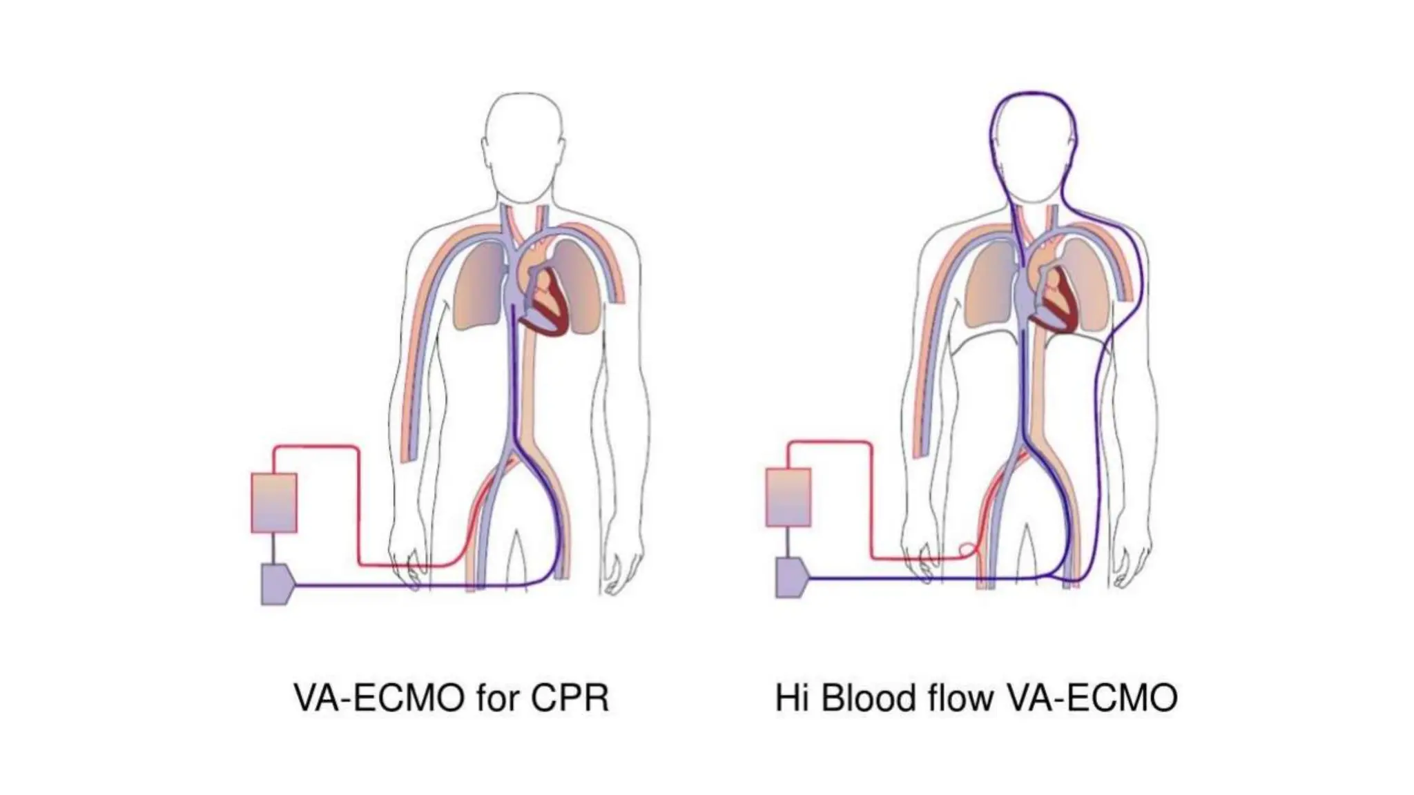 ecmo extracorporeal membrane oxygenarator | PPTX