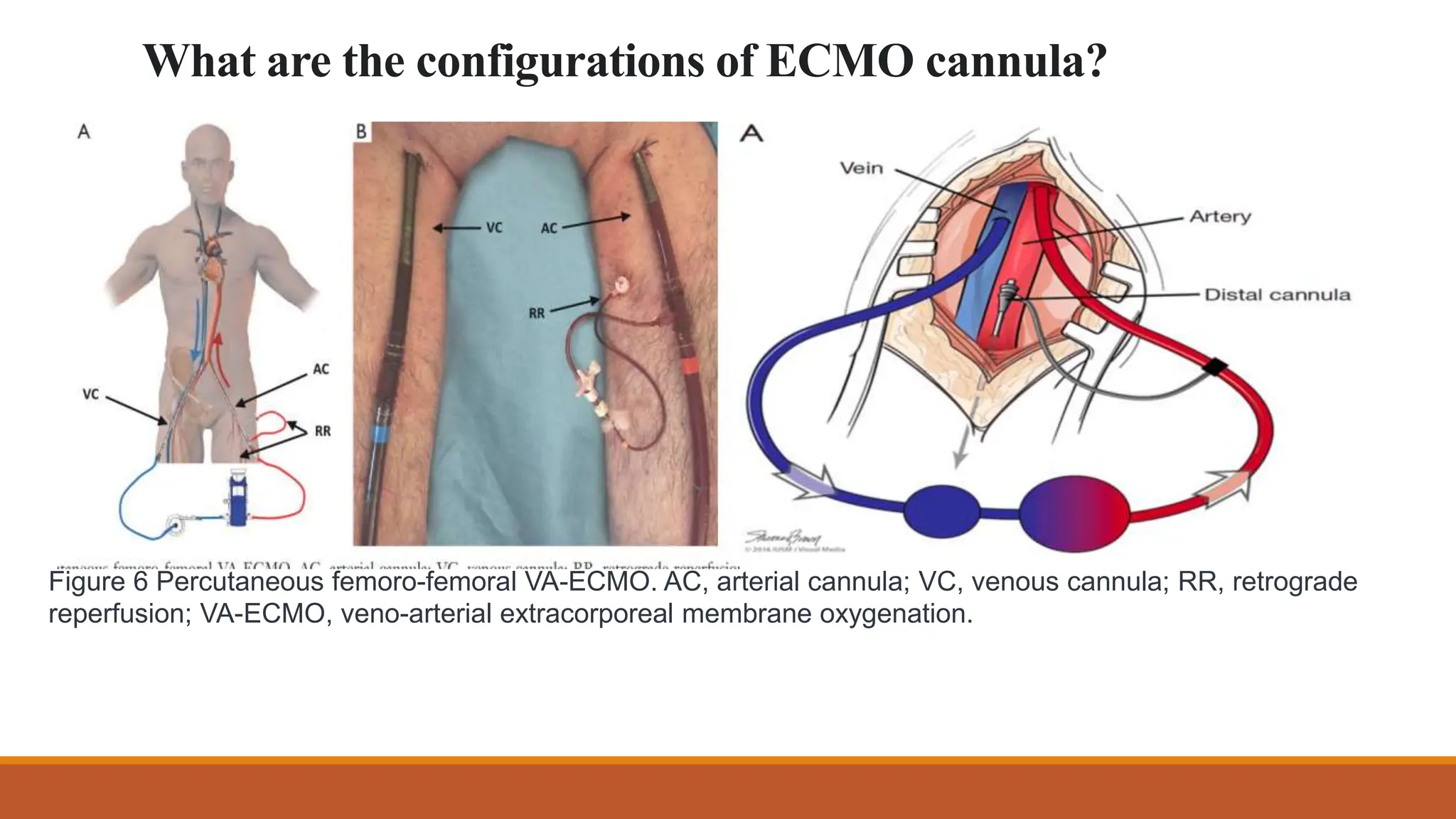 Extracorporeal Membrane Oxygenation (ECMO) | PPTX | Lung and Respiratory Health | Diseases and ...