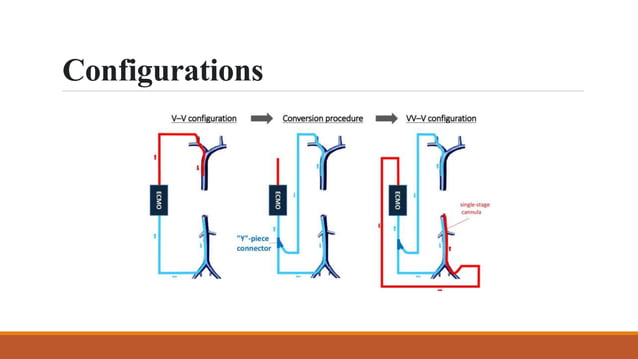 Extracorporeal Membrane Oxygenation (ECMO) | PPTX | Lung and Respiratory Health | Diseases and ...