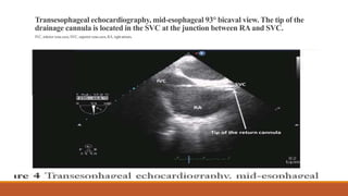 Extracorporeal Membrane Oxygenation (ECMO) | PPTX