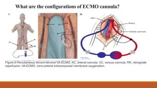 Extracorporeal Membrane Oxygenation (ECMO) | PPTX | Lung and Respiratory Health | Diseases and ...