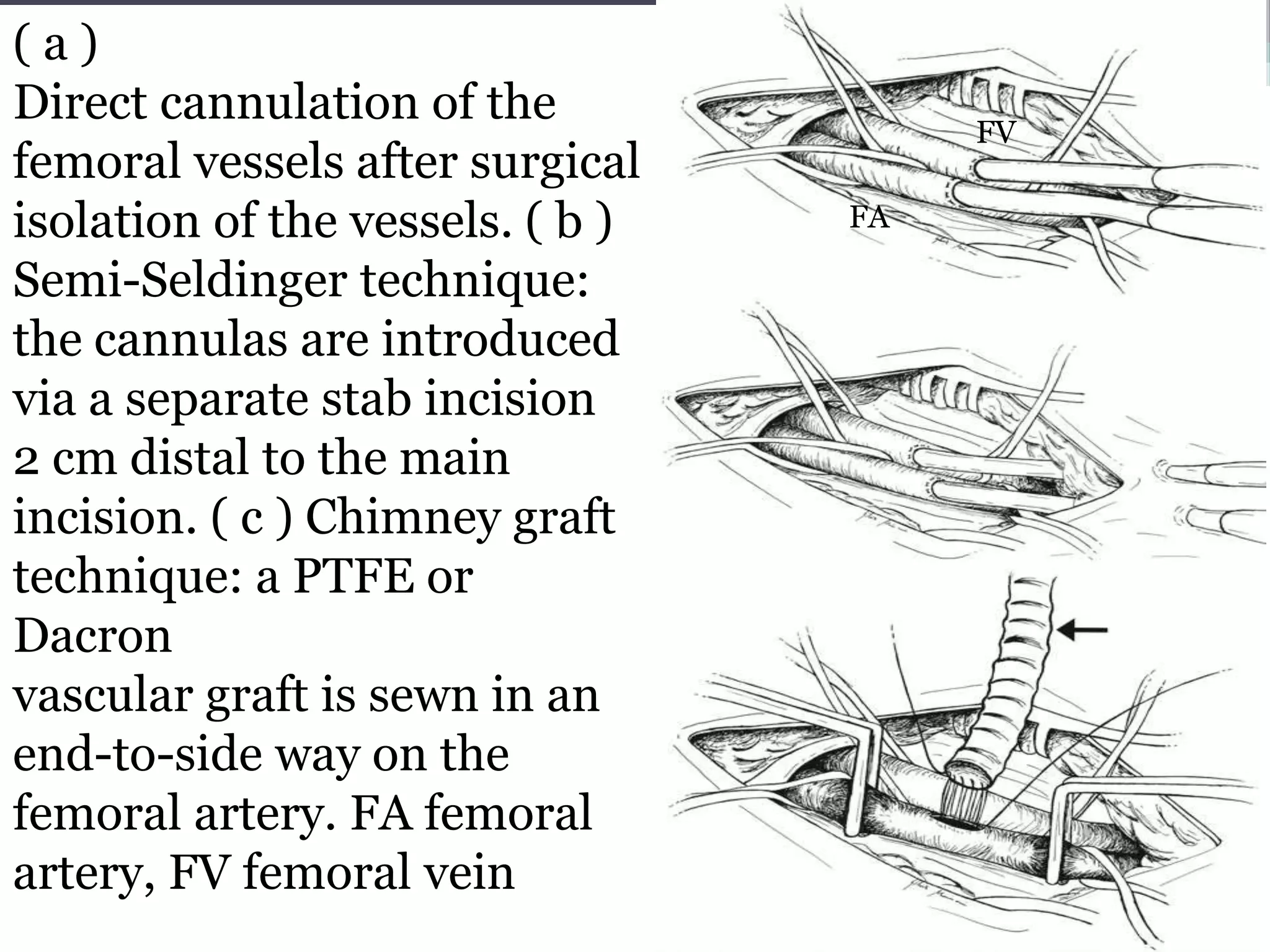 ECMO - selection.pptx