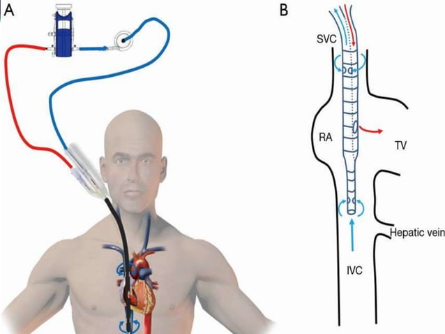 ECMO - selection.pptx