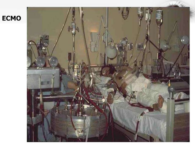 Ecmo dr himaaldev | PPT