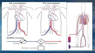 Ecmo nurse presentation | PPTX