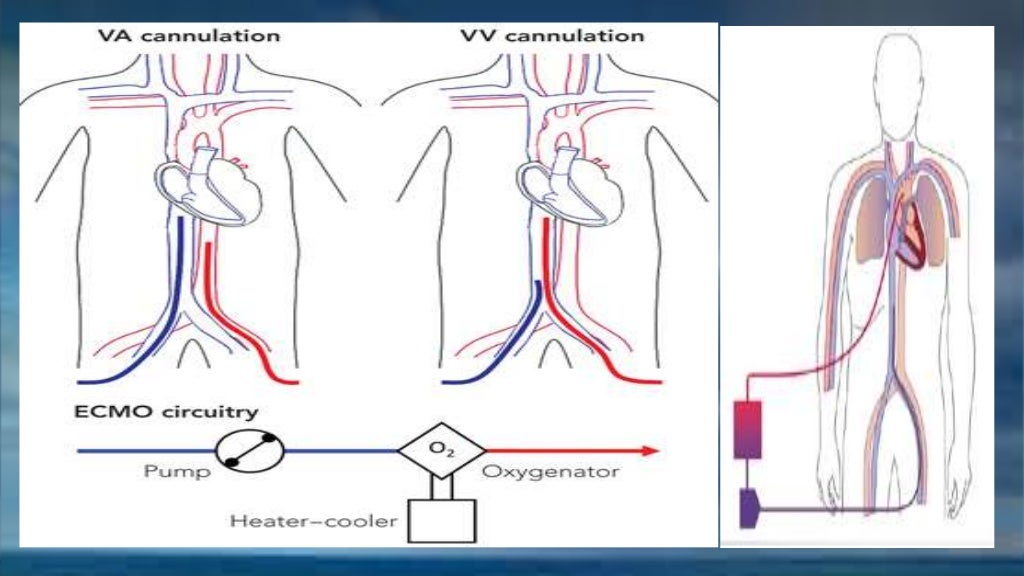 Ecmo nurse presentation