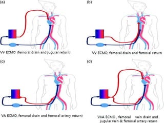 ECMO.pptx