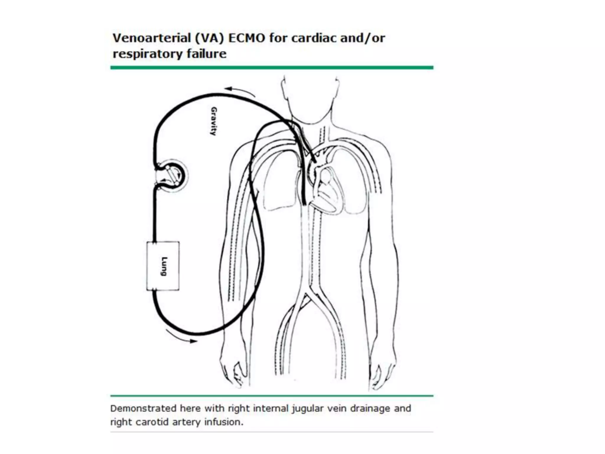 ECMO | PPTX