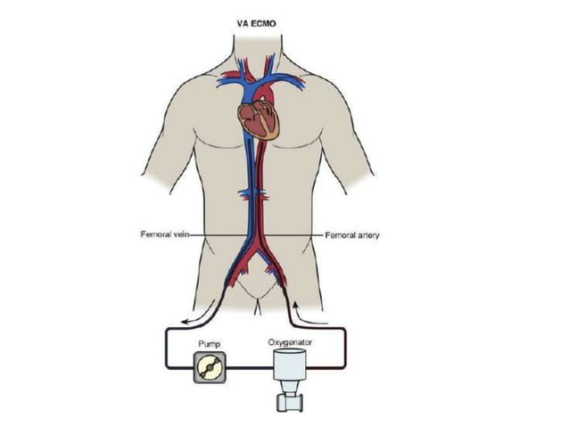 ECMO | PPTX | Heart and Cardiovascular Diseases | Diseases and Conditions