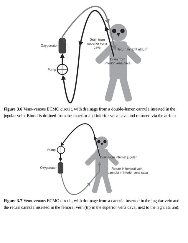 Ecmo book | PDF