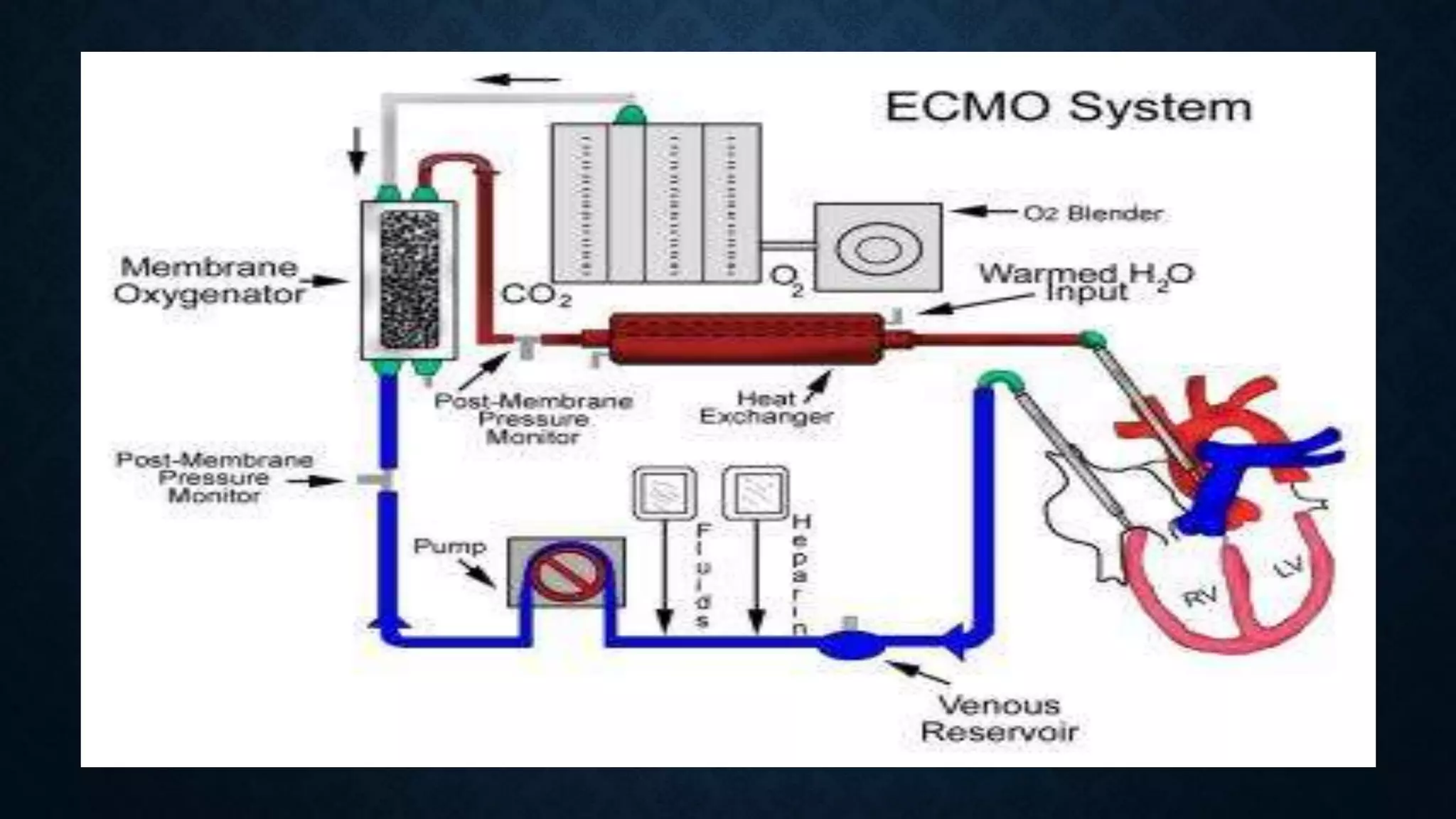 Ecmo ( extracorporeal membrane oxygenation ) | PPTX