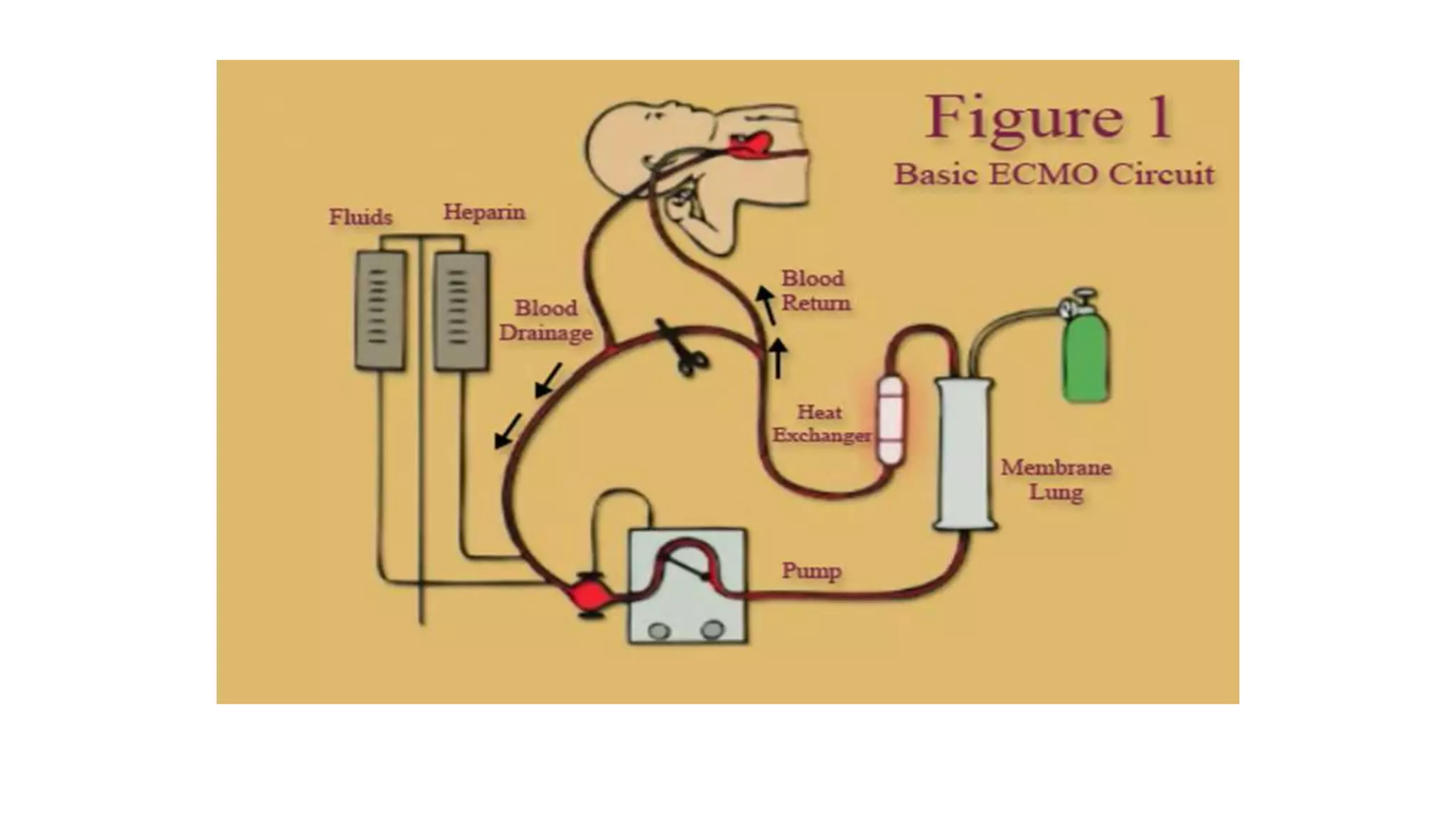 ECMO - extracorporeal membrane oxygenation | PPTX | Lung and Respiratory Health | Diseases and ...