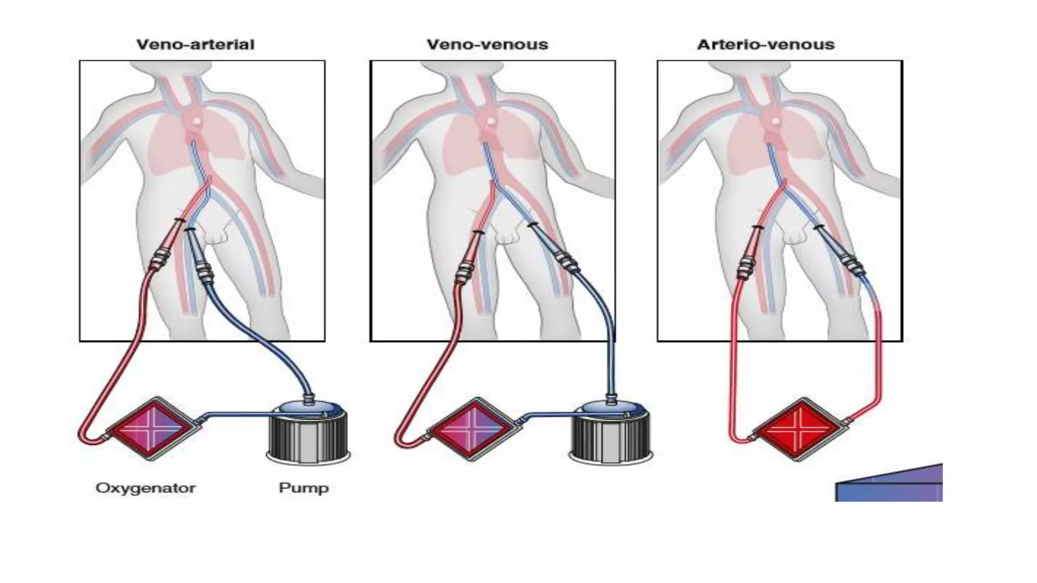 ECMO - extracorporeal membrane oxygenation | PPTX | Lung and Respiratory Health | Diseases and ...