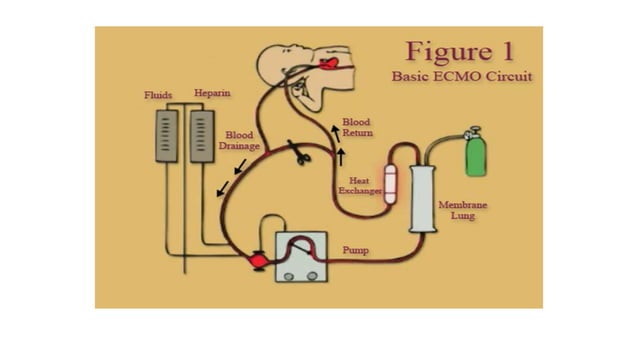 ECMO - extracorporeal membrane oxygenation | PPTX | Lung and Respiratory Health | Diseases and ...