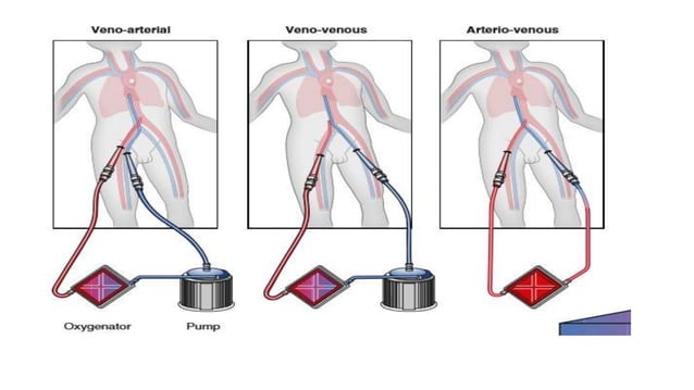 ECMO - extracorporeal membrane oxygenation | PPTX | Lung and ...