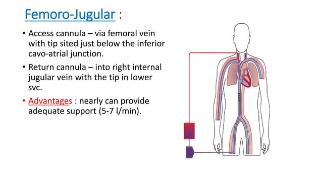 ECMO - extracorporeal membrane oxygenation | PPTX | Lung and Respiratory Health | Diseases and ...