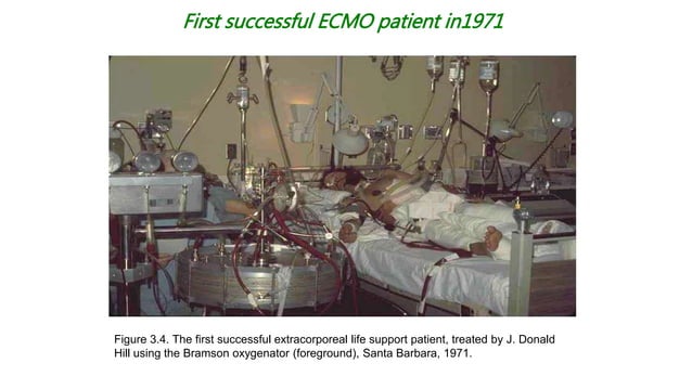 ECMO - extracorporeal membrane oxygenation | PPTX | Lung and Respiratory Health | Diseases and ...