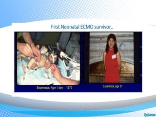 Ecmo | PPTX