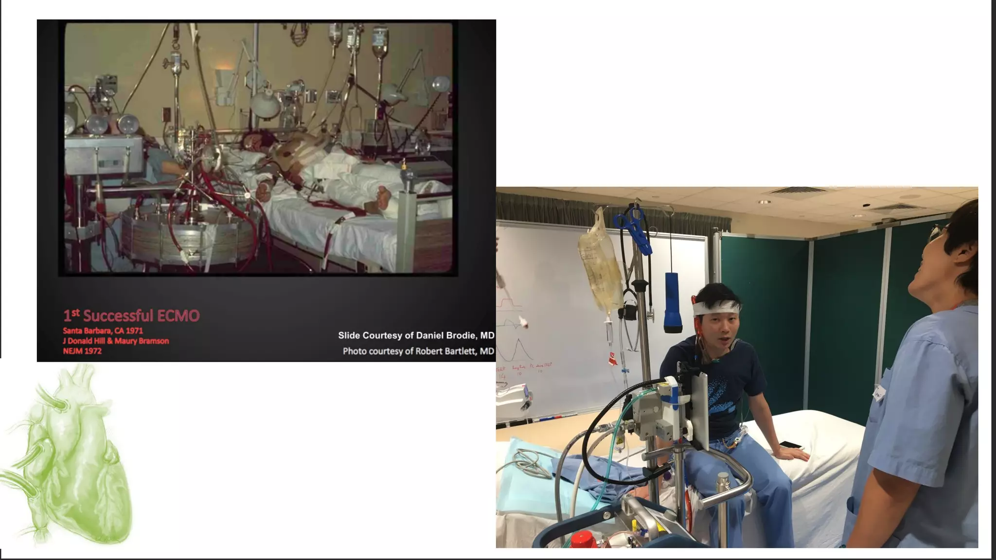 Ecmo history, indications, cannulation, complications | ODP