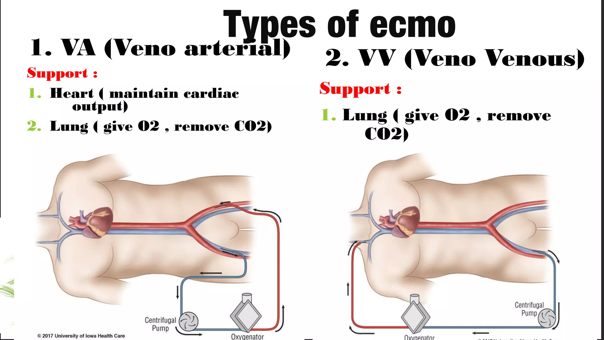 Ecmo history, indications, cannulation, complications | ODP