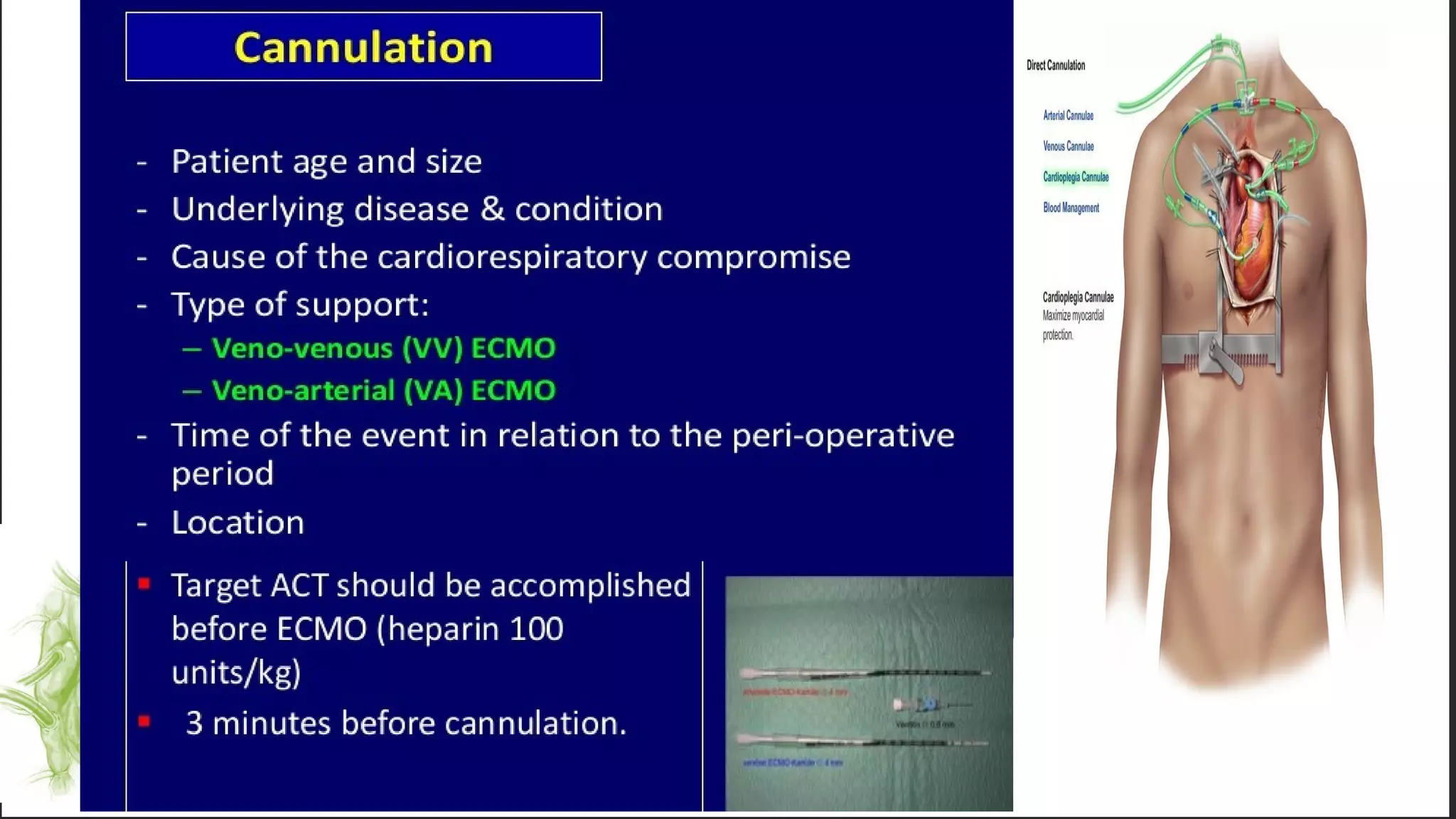 Ecmo history, indications, cannulation, complications | ODP