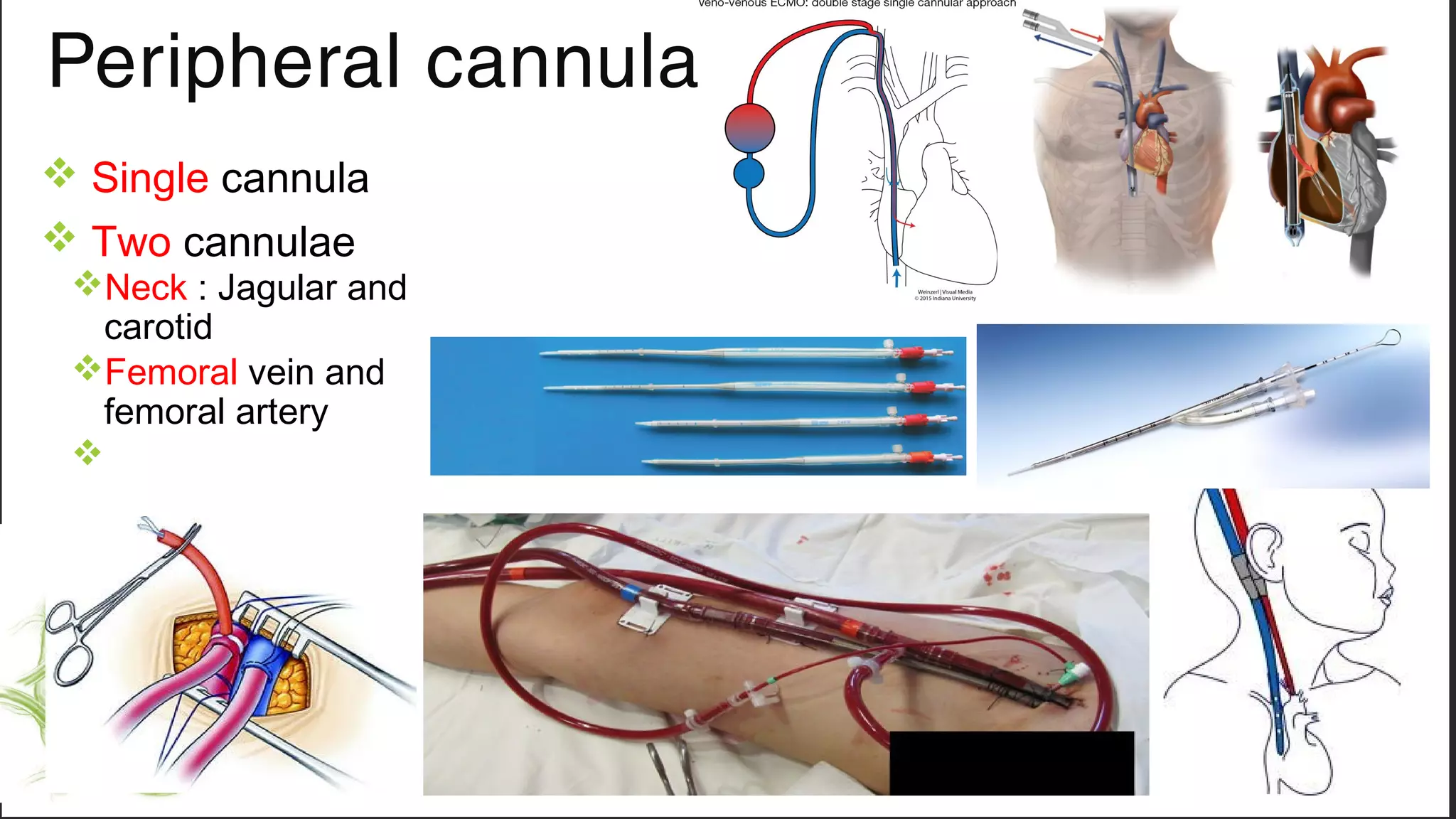 Ecmo history, indications, cannulation, complications | ODP