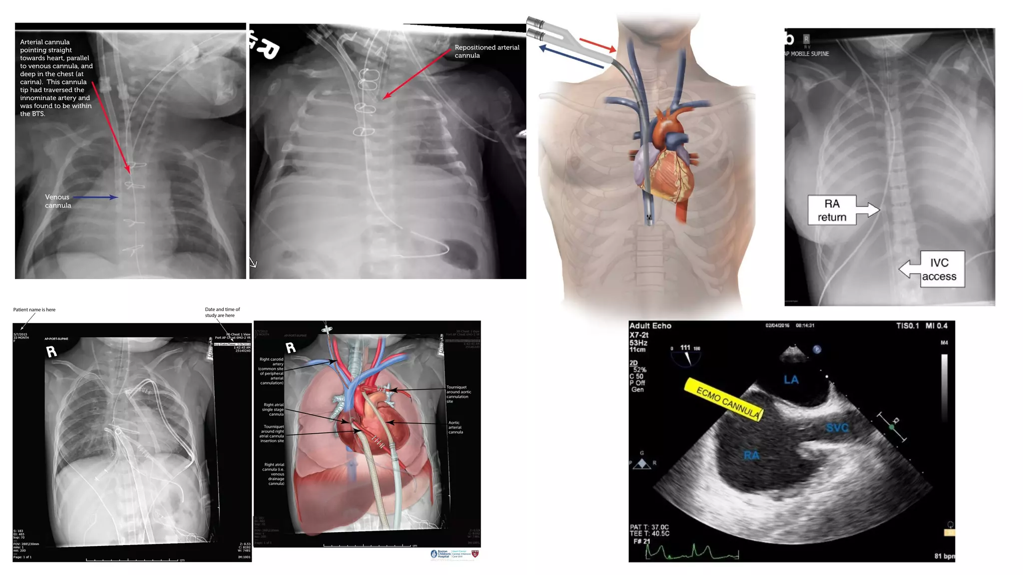 Ecmo history, indications, cannulation, complications | ODP
