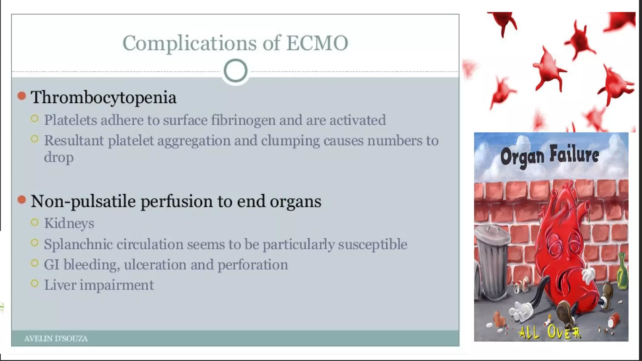Ecmo history, indications, cannulation, complications | ODP