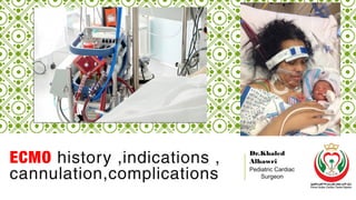 Ecmo history, indications, cannulation, complications | ODP
