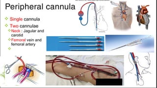 Ecmo history, indications, cannulation, complications | ODP