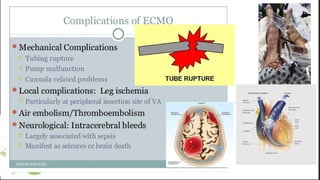 Ecmo history, indications, cannulation, complications | ODP