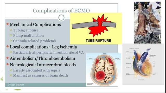 Ecmo history, indications, cannulation, complications | ODP | Lung and Respiratory Health ...