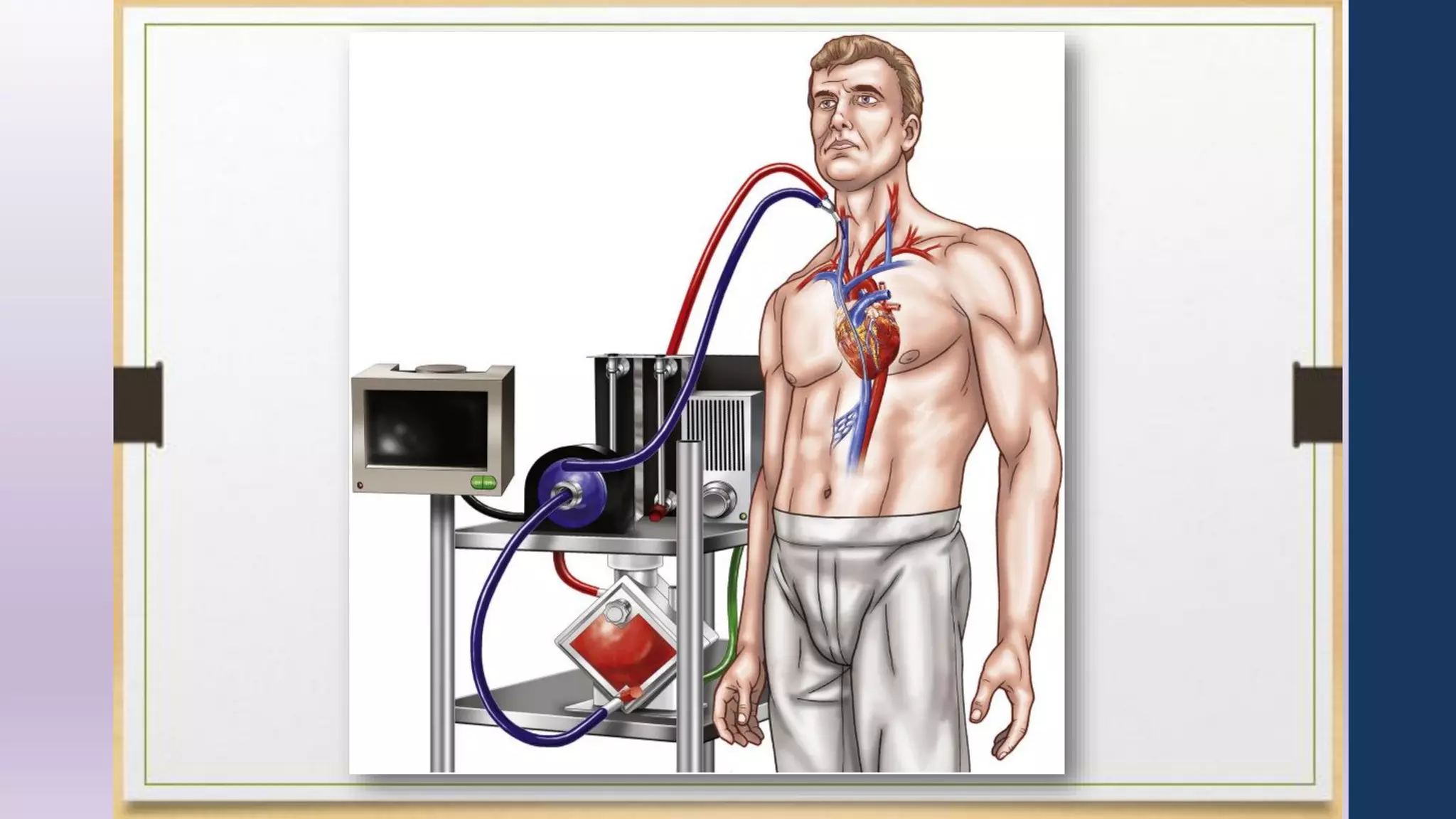 ECMO in Critical Care | PDF | Lung and Respiratory Health | Diseases and Conditions