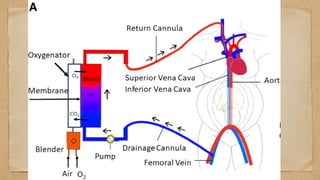 ECMO IN PREGNANCY critical care medicine.pptx