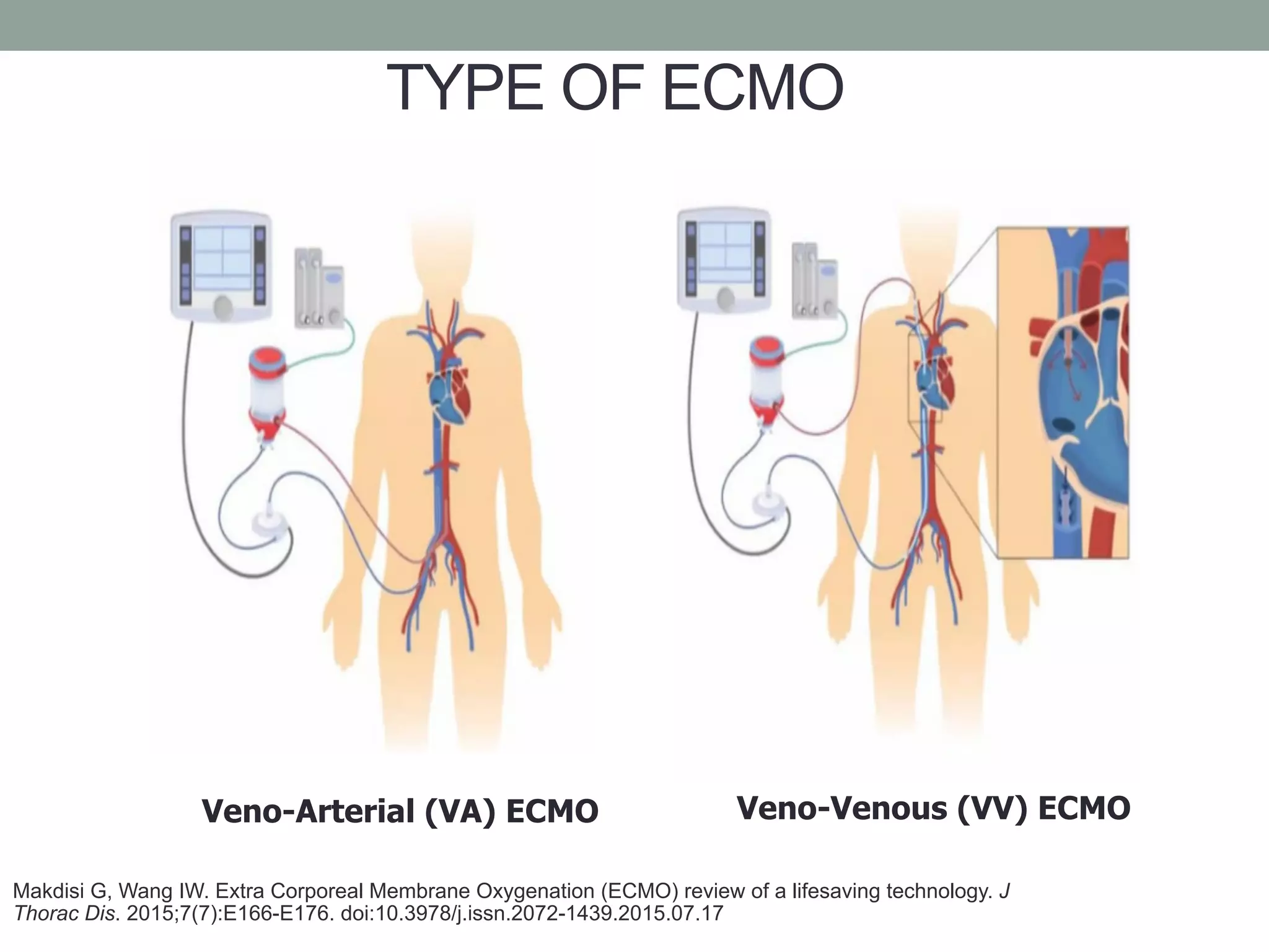 ECMO kanulasi harkit July.pdf