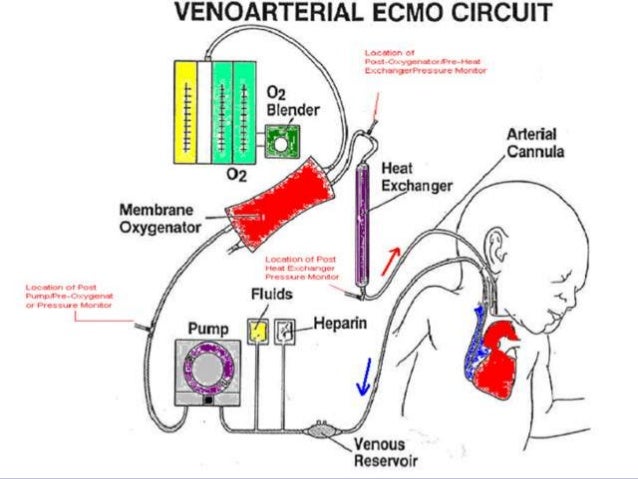 ECMO - Part 1 by Dr.Tinku Joseph