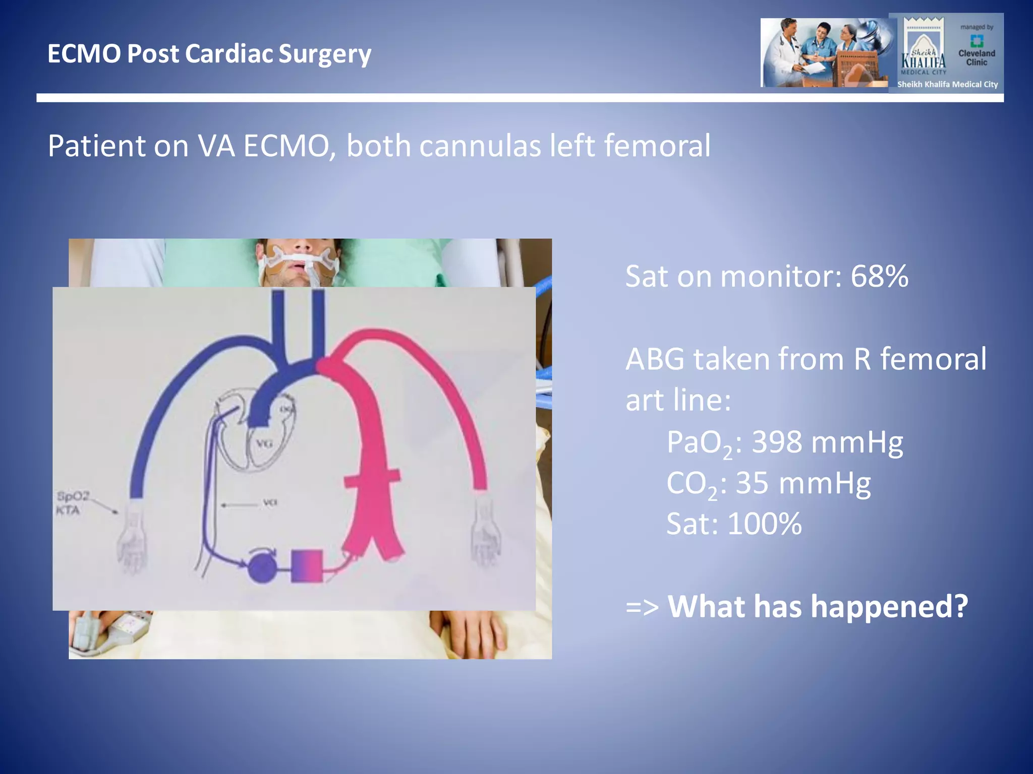 Ecmo Post Cardiac Surgery | PDF