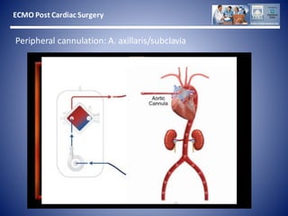 Ecmo Post Cardiac Surgery | PDF