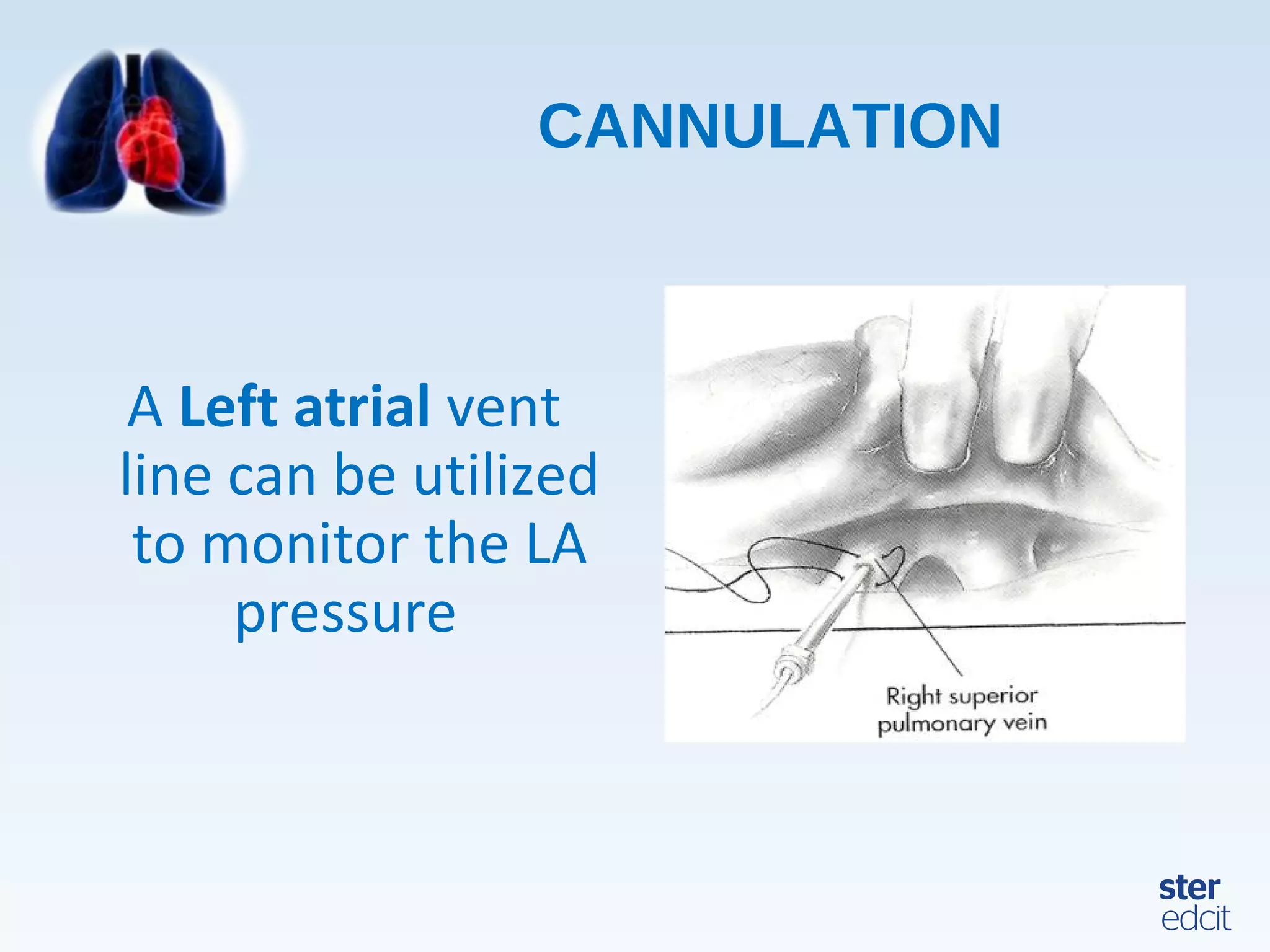 Ecmo presentation final | PPT