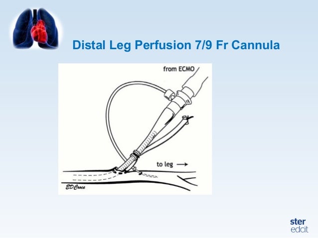 Ecmo presentation final