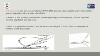 ecmo .pptx