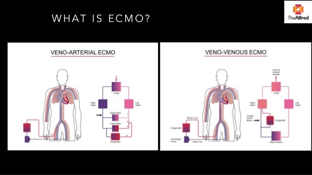 ECMO: What Could Go Wrong? by Murphy