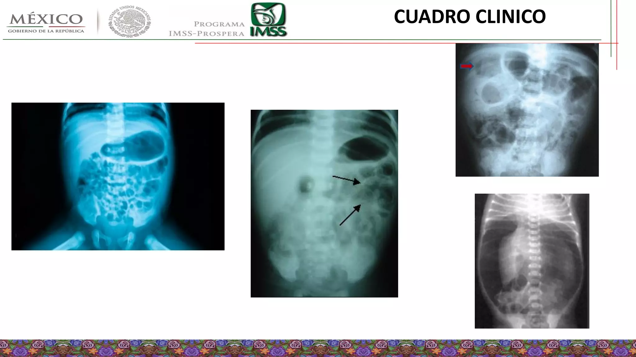 Enterocolitis Necrotizante | PDF | Digestive Disorders | Diseases and ...
