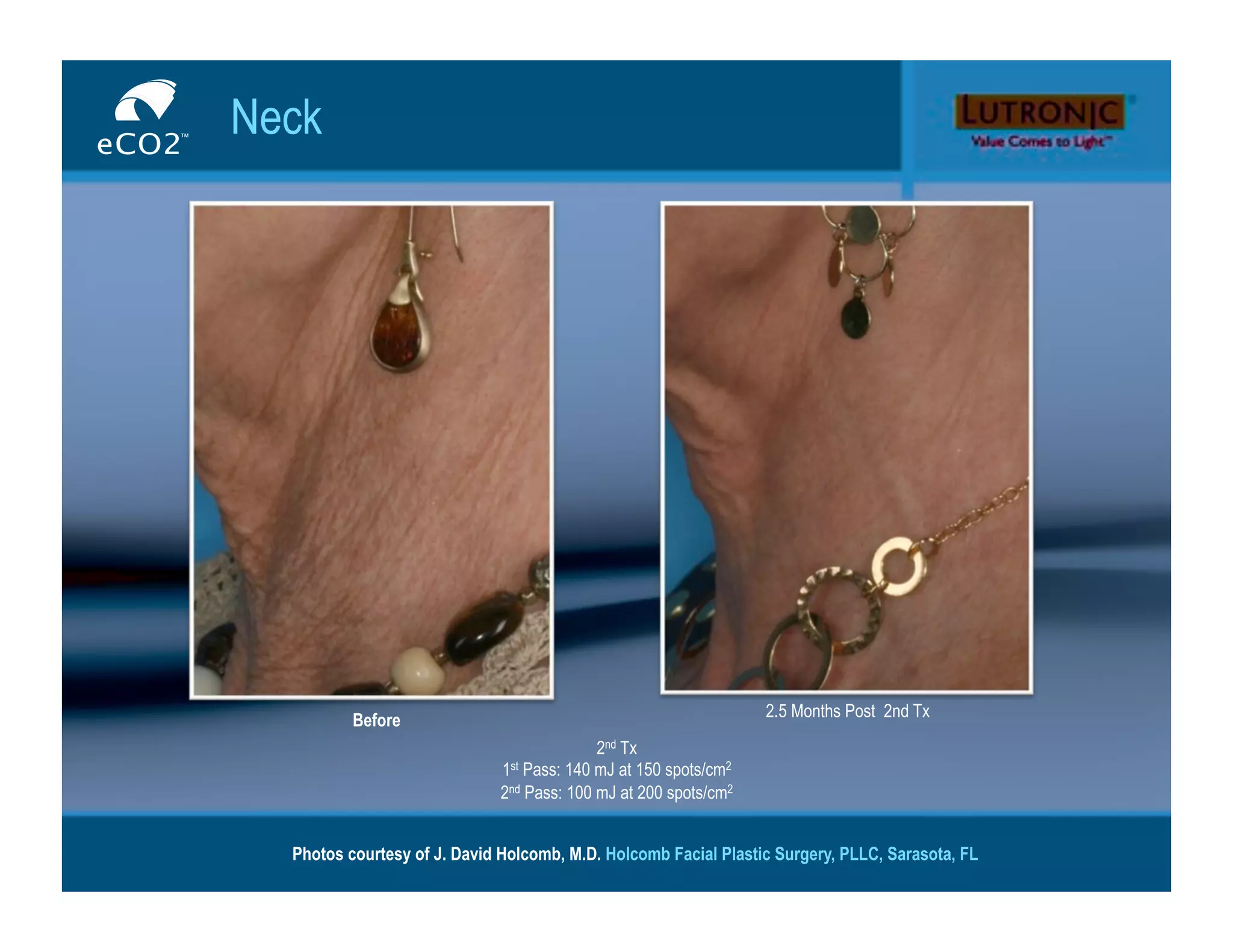 eCO2 Fractional Before After Photos | PDF